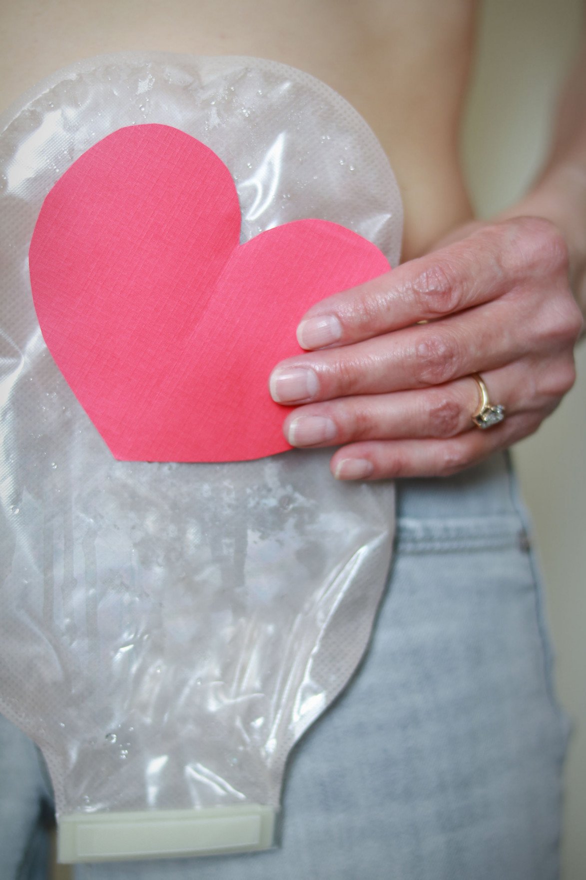 Wat is een stoma en stomazorg? - Thuisverpleging in Belgie